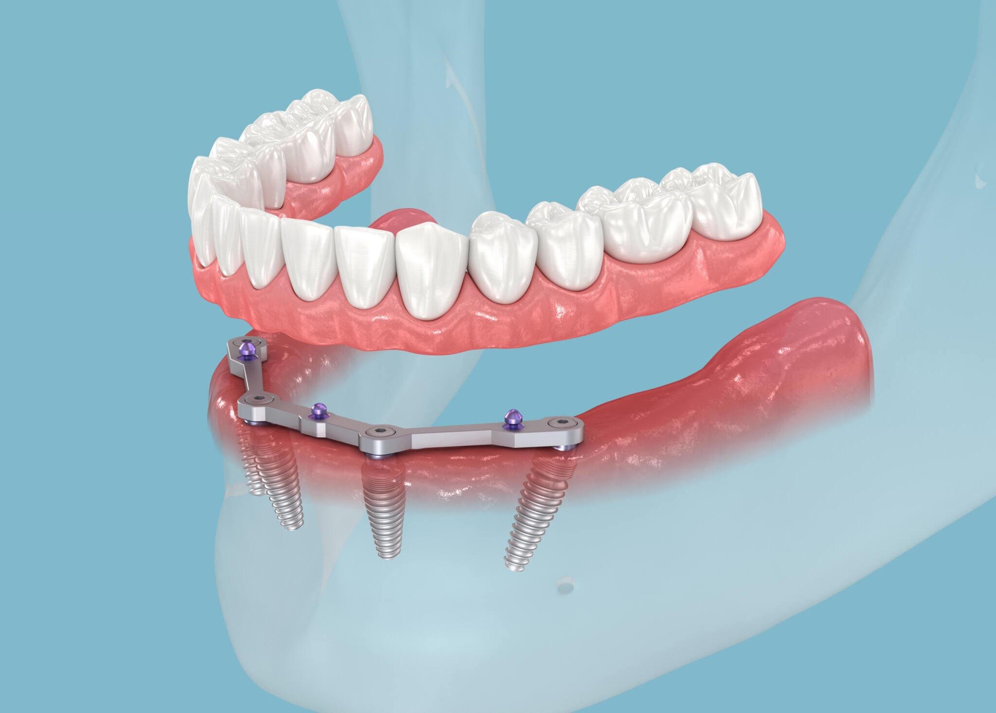 4 Types of Dental Implants